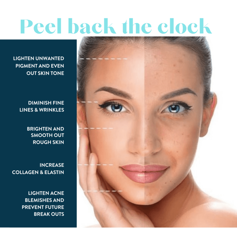 Chemical Peel Treatment in Merritt Island, FL - BCSG